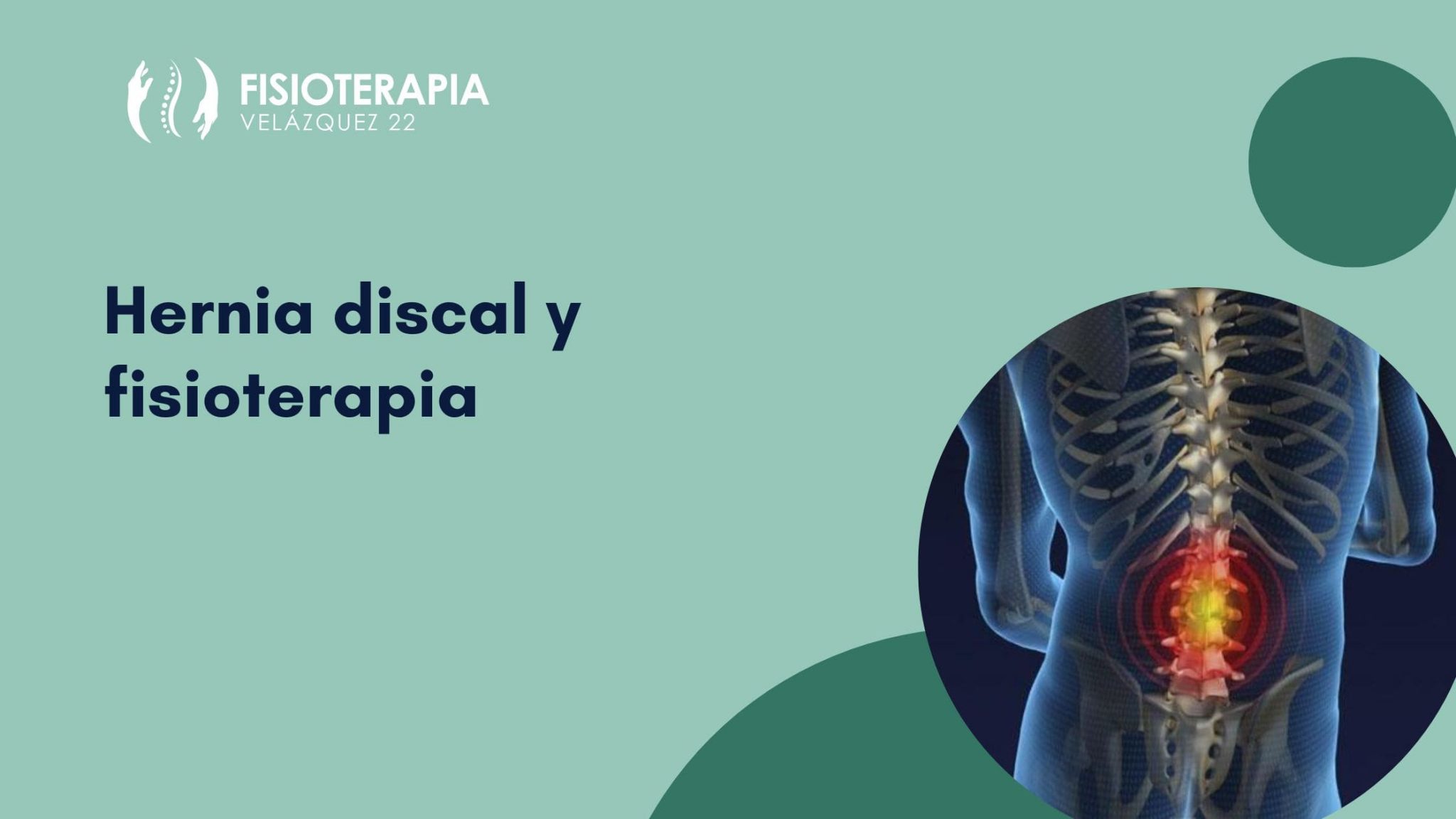 Hernia discal y fisioterapia - Fisioterapia Velázquez 22